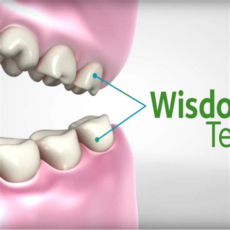Types Of Impacted Wisdom Teeth