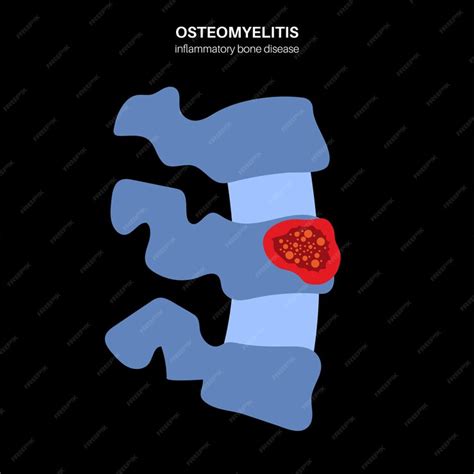 Premium Vector Vertebral Osteomyelitis Infected Spine Bones