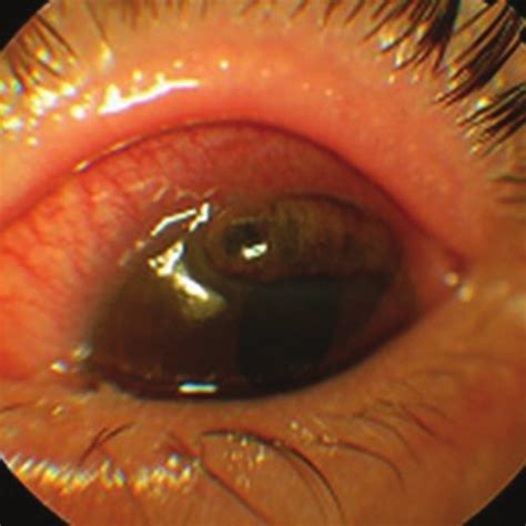 Corneal Patch Grafts And Amniotic Membrane Transplant Of The Left Eye