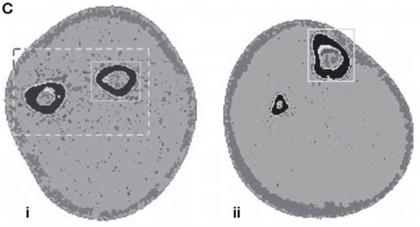 Peripheral Quantitative Computed Tomography The Scan Site Is Located Download Scientific