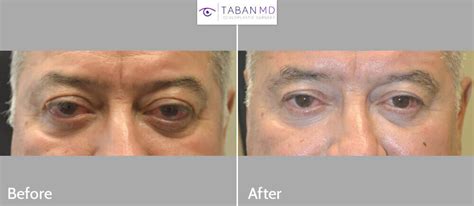 Graves Disease Before And After Gallery Taban Md