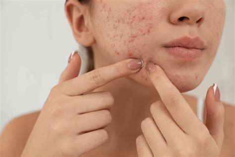 Dermatological Treatments For Acne Scars Vs Home Treatments Stratum