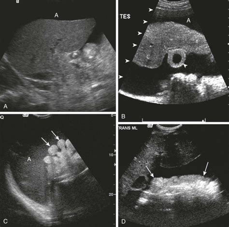 Ascites And Peritoneal Fluid Collections Radiology Key