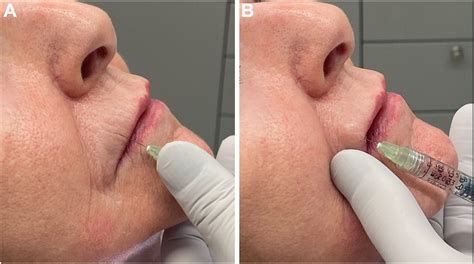 Perioral Filler Augmentation Atlas Of The Oral And Maxillofacial