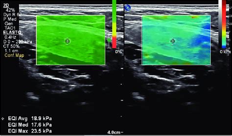 Shear Wave Elastography Of The Right Submandibular Gland A Confidence Download Scientific