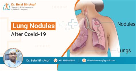 What Is The Most Common Cause Of Multiple Nodules In Lung