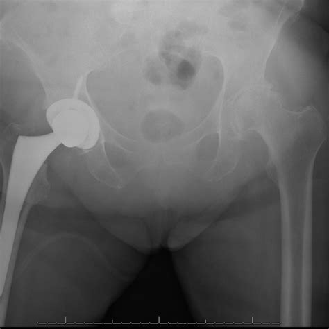 Right Total Hip Arthroplasty Download Scientific Diagram