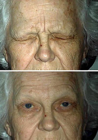Orbicularis Oculi Muscle Origin And Insertion And Function