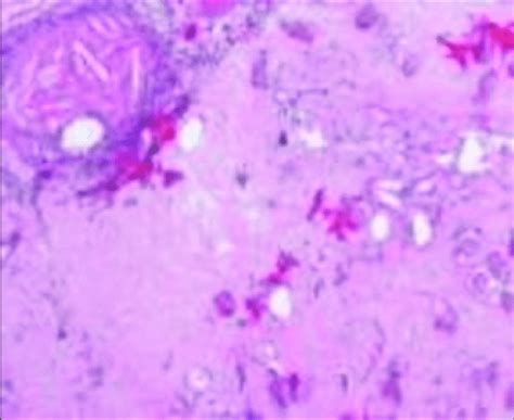 Histological Examination Confirmed The Diagnosis Of Dermoid Tumor
