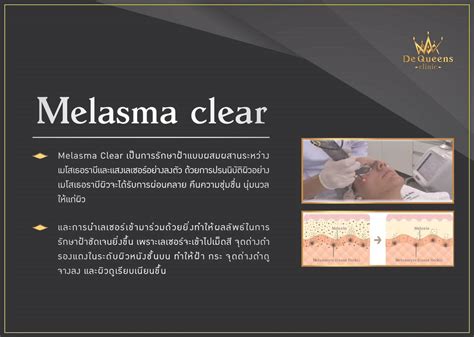 รักษาฝ้าชลบุรี เพชรบุรี Melasma Clear