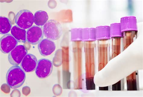 Nieuwe Behandeling Van Leukemie Vermindert Bijwerkingen Vib Ku Leuven De Specialist