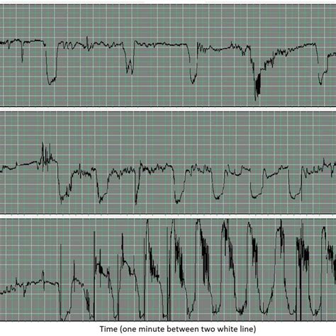 Evolution Of Fetal Heart Rate Decelerations During Umbilical Cord