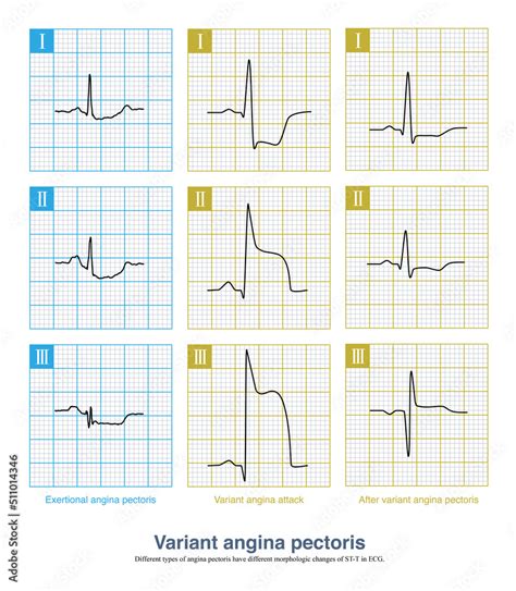 Variant Angina