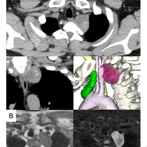 A Chest Computed Tomography Ct Shows A 50 Cm Mass In The Thoracic