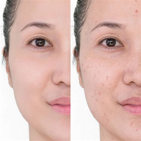 Tazarotene Vs Tretinoin Dermatologists Best Kept Secrets