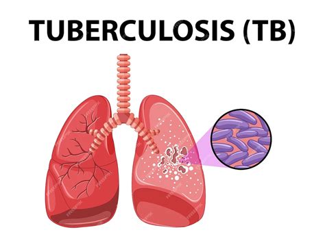 Premium Vector Human Anatomy Of Lung With Tuberculosis Infographic