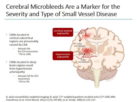 Extraordinary Cases In Stroke Prevention Ppt Download