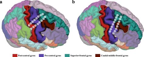 Representative Location Of Permanent Electrode Array Placement Of Two