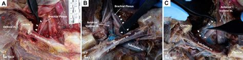 Nerve Branching Pattern Entering Into The Subclavius And Removal Of The