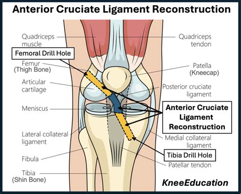 Acl Surgery Anterior Cruciate Ligament Tear Reconstruction Knee