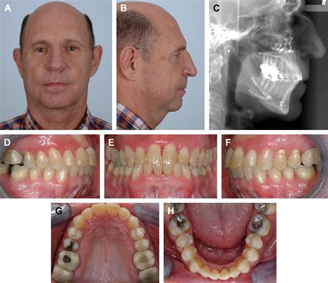 Management Of Obstructive Sleep Apnea By Maxillomandibular Advancement