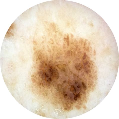 Molescope™ Smartphone Dermatoscope For Digital Dermoscopy