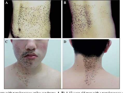 Figure 1 From Papular Nevus Spilus Syndrome Old And New Aspects Of A
