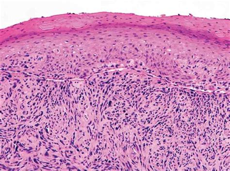 What Is Spindle Cell Sarcoma Klarity Health Library
