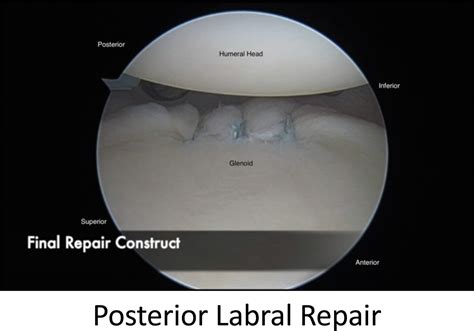 Posterior Labral Repair Using Knotless All Suture” Suture Anchors