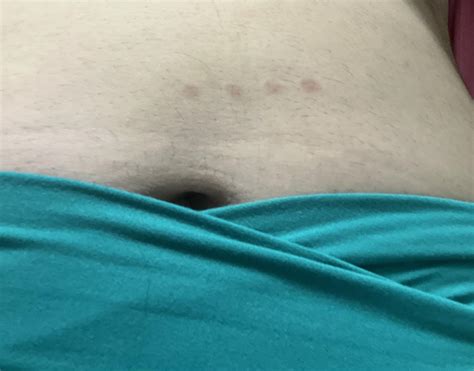 Is This Tinea Versicolor R Pityriasisversicolor