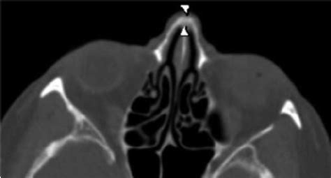 Nasal Bone Anatomy Ct The Facial Mid Sagittal Computed Tomography Scan