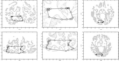Locations Of The Strongest Cortical Source Peak Pseudo T In The