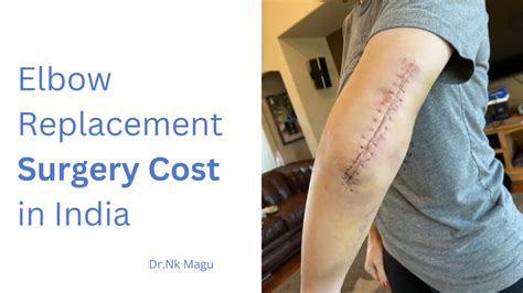 Elbow Replacement Surgery Cost In India Dr Nk Magu