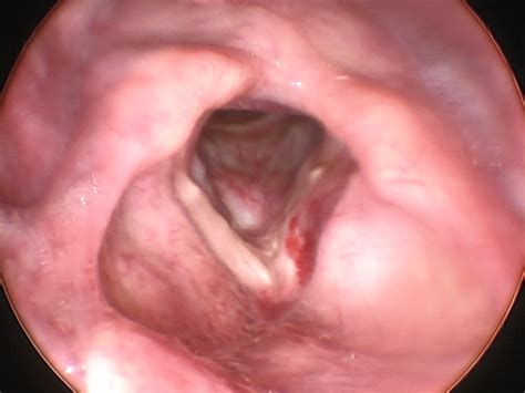 Vocal Cord Injection With Prolaryn Gel With Videostroboscopy Transoral