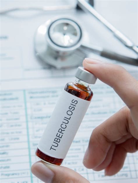 Tuberculosis Second Most Deadly Infectious Disease Claims Over 3 Lakh
