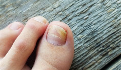 Toenail Fungus Symptoms And Treatment In Singapore