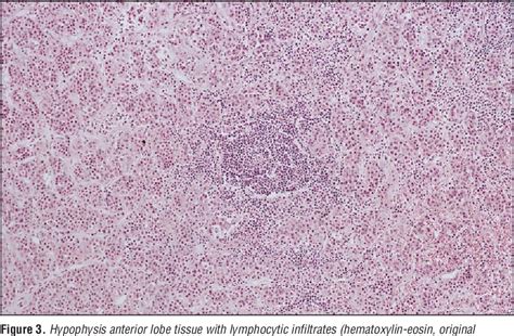 Figure 1 From Lymphocytic Hypophysitis Associated With Dacryoadenitis