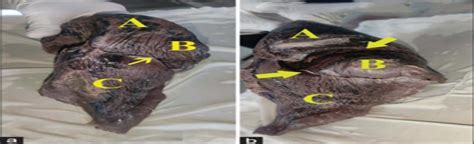 Dr Kosuri Kalyan Chakravarthi On Linkedin Congenital Rare Abnormal