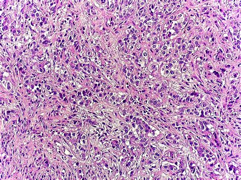 Figure 3 Moderately Differentiated Hepatocellular Carcinoma He