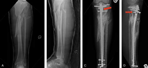 Preoperative A Ap And B Lateral Radiographs Of A Proximal Third Download Scientific Diagram