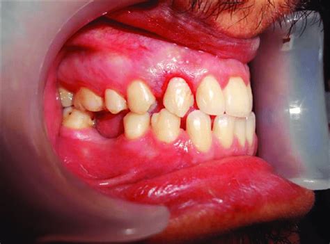 Gingivectomy On The Tooth 23 Download Scientific Diagram