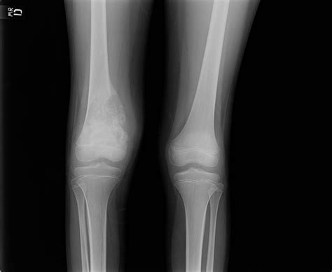 Osteosarcoma Distal Femur Image Radiopaediaorg
