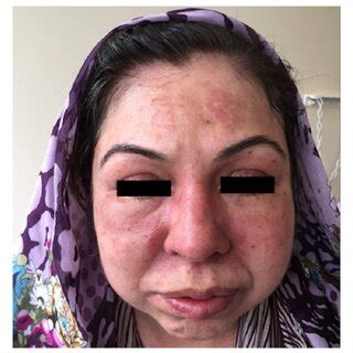 Skin And Muscle Involvement A Rash On Her Face And B Bilateral Download Scientific Diagram