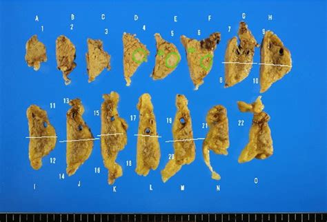 The Macroscopic Findings Of The Resected Specimen Two Solid Masses