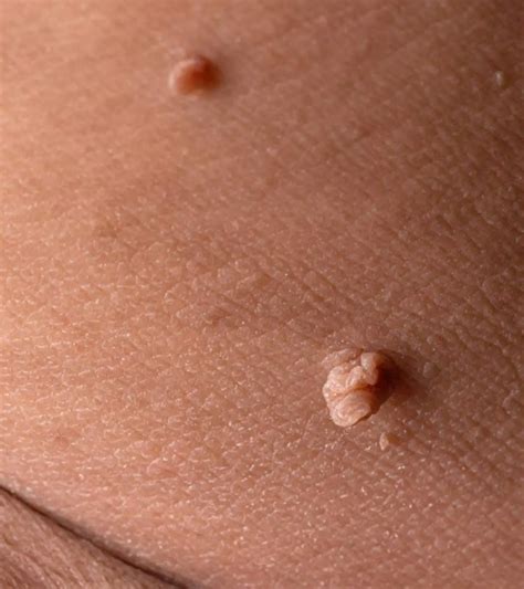 Genital Skin Tags 4 Safe Removal And Prevention Tips