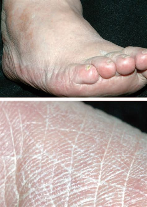 Mild Tinea Pedis