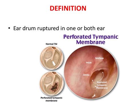 Complete Tympanic Membrane Perforation