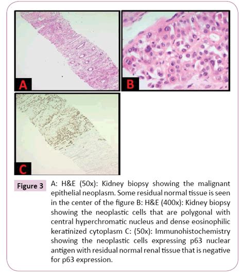 Renal Squamous Cell Carcinoma Rare And Aggressive Variant Of Renal