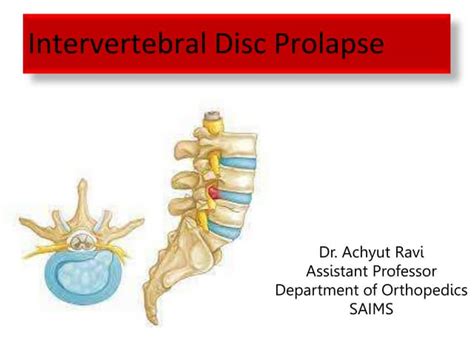 Prolapse Intervertebral Disc Lecturepdf