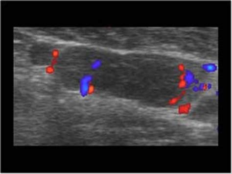 Head And Neck 44 Lymph Nodes Case 441 Benign Lymph Nodes Ultrasound Cases